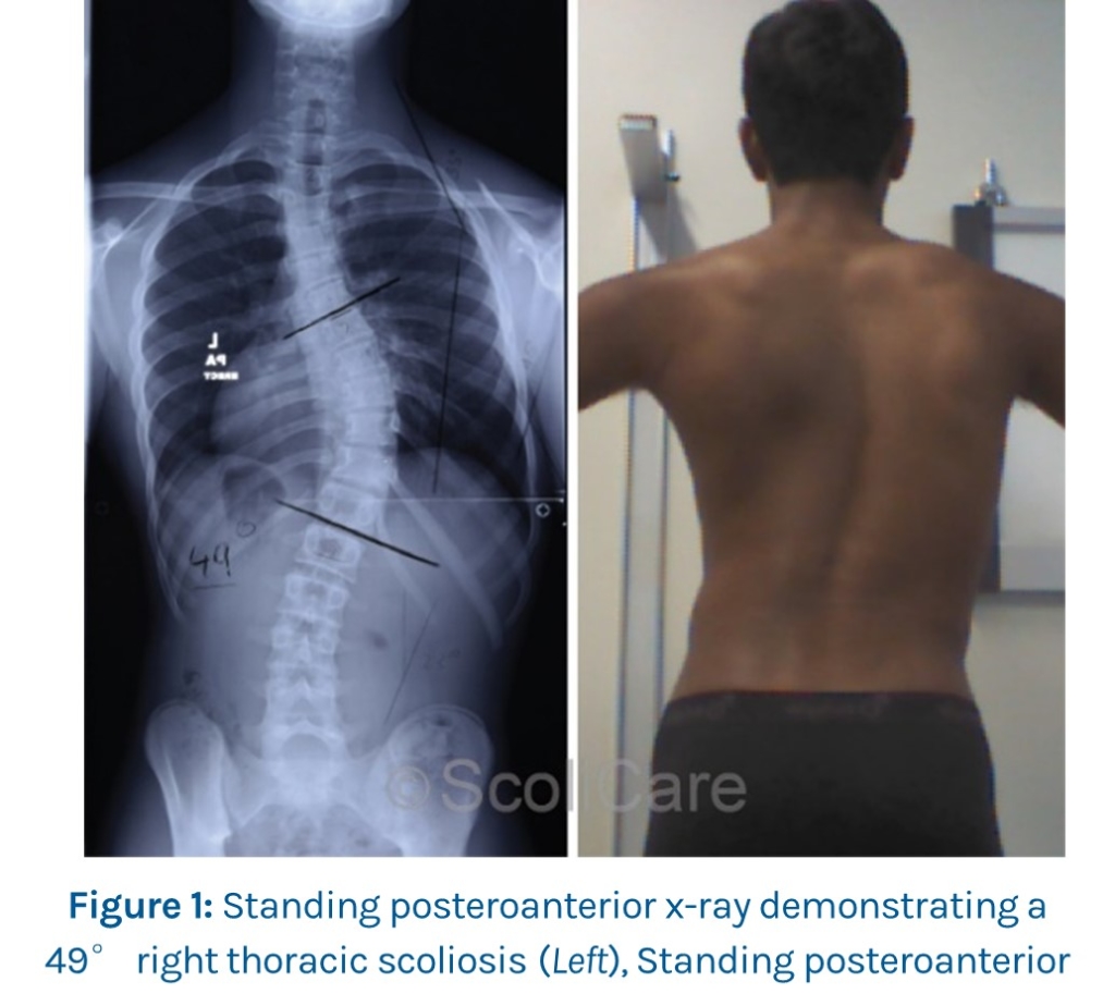 Case Study: Reduction of severe scoliosis in 14 year old male – ScoliBrace