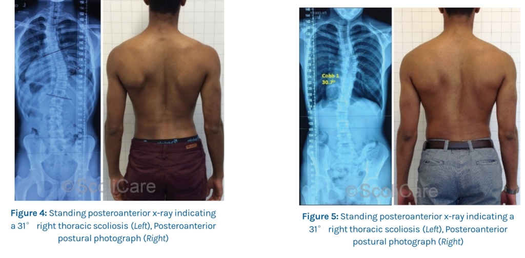Case Study: Reduction of severe scoliosis in 14 year old male – ScoliBrace