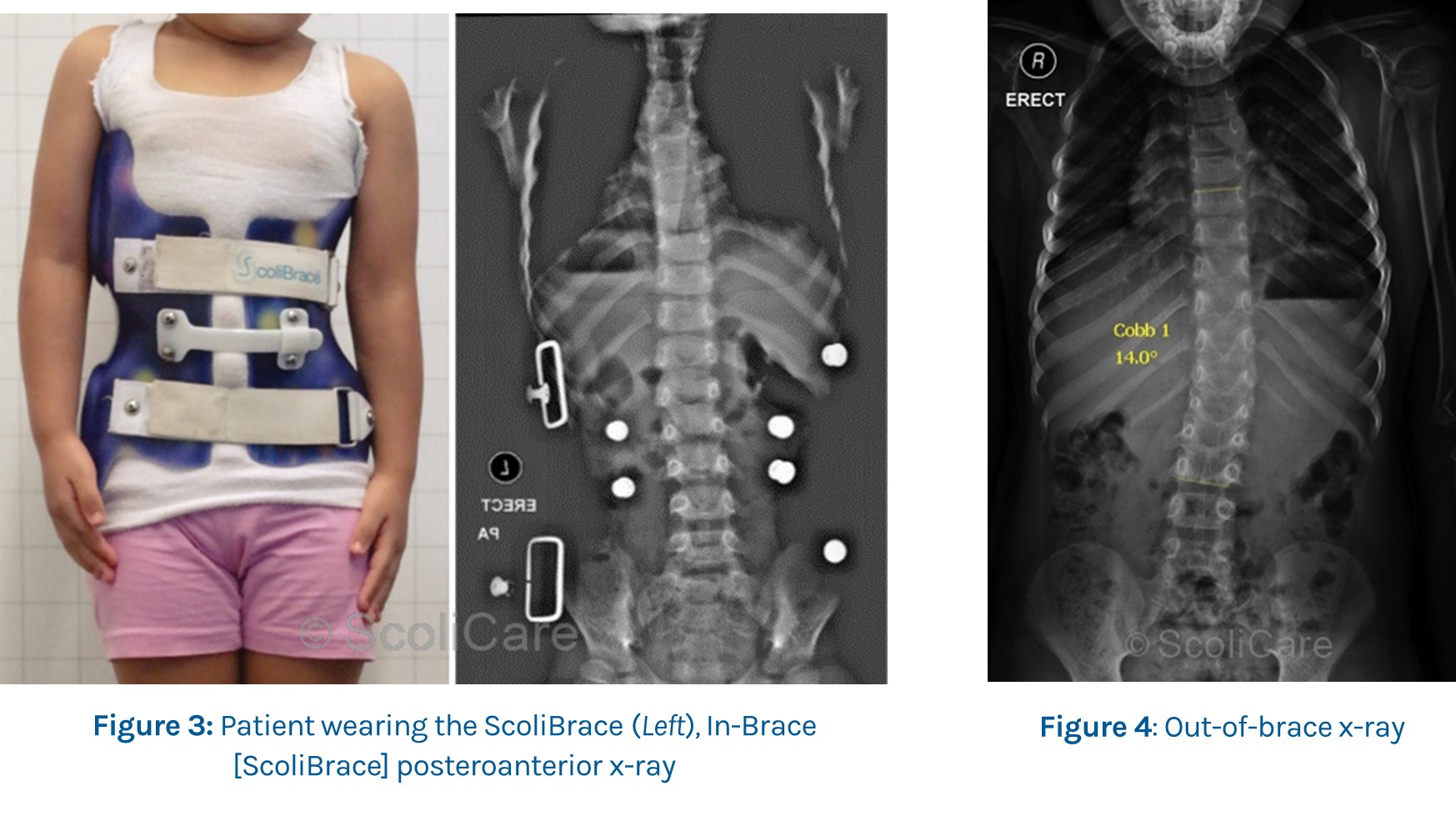Case Study: Treatment of a moderate sized infantile scoliosis – ScoliBrace