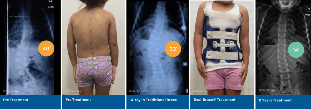 Case Study: Treatment of a moderate sized infantile scoliosis – ScoliBrace