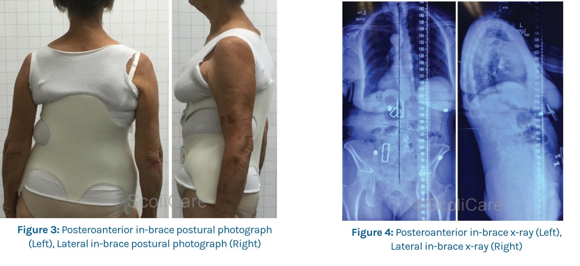 Case Study: Improvements in pain, function in 78 year old ScoliBrace