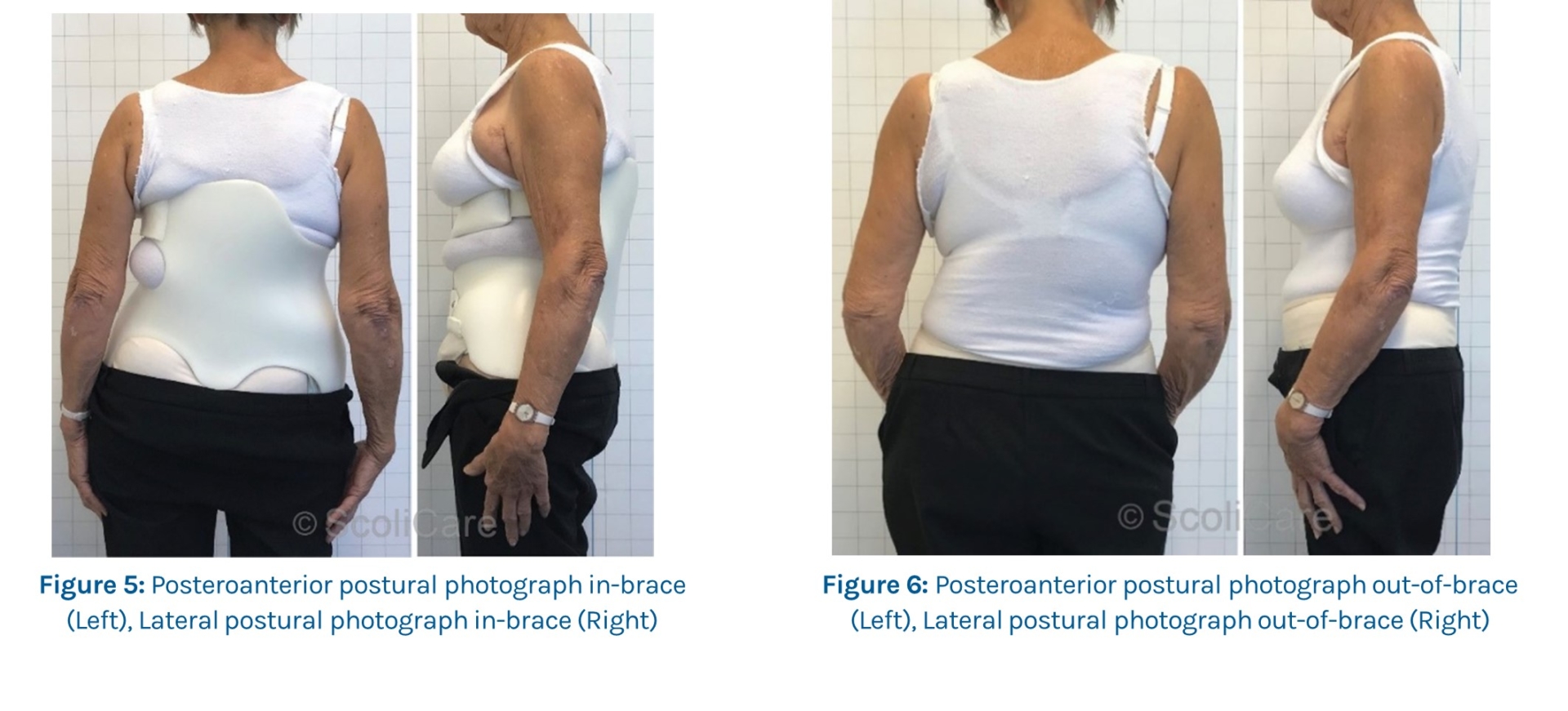 Case Study: Improvements in pain, function in 78 year old ScoliBrace