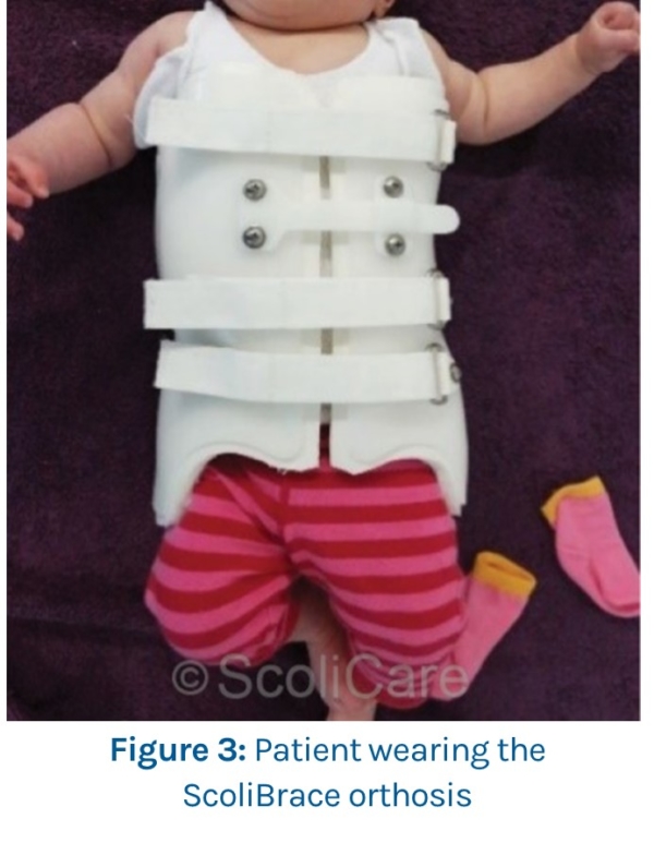 Case – 11 week old female infantile patient – ScoliBrace