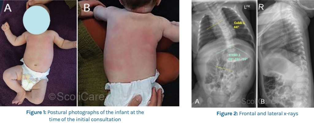 Case – 11 week old female infantile patient – ScoliBrace