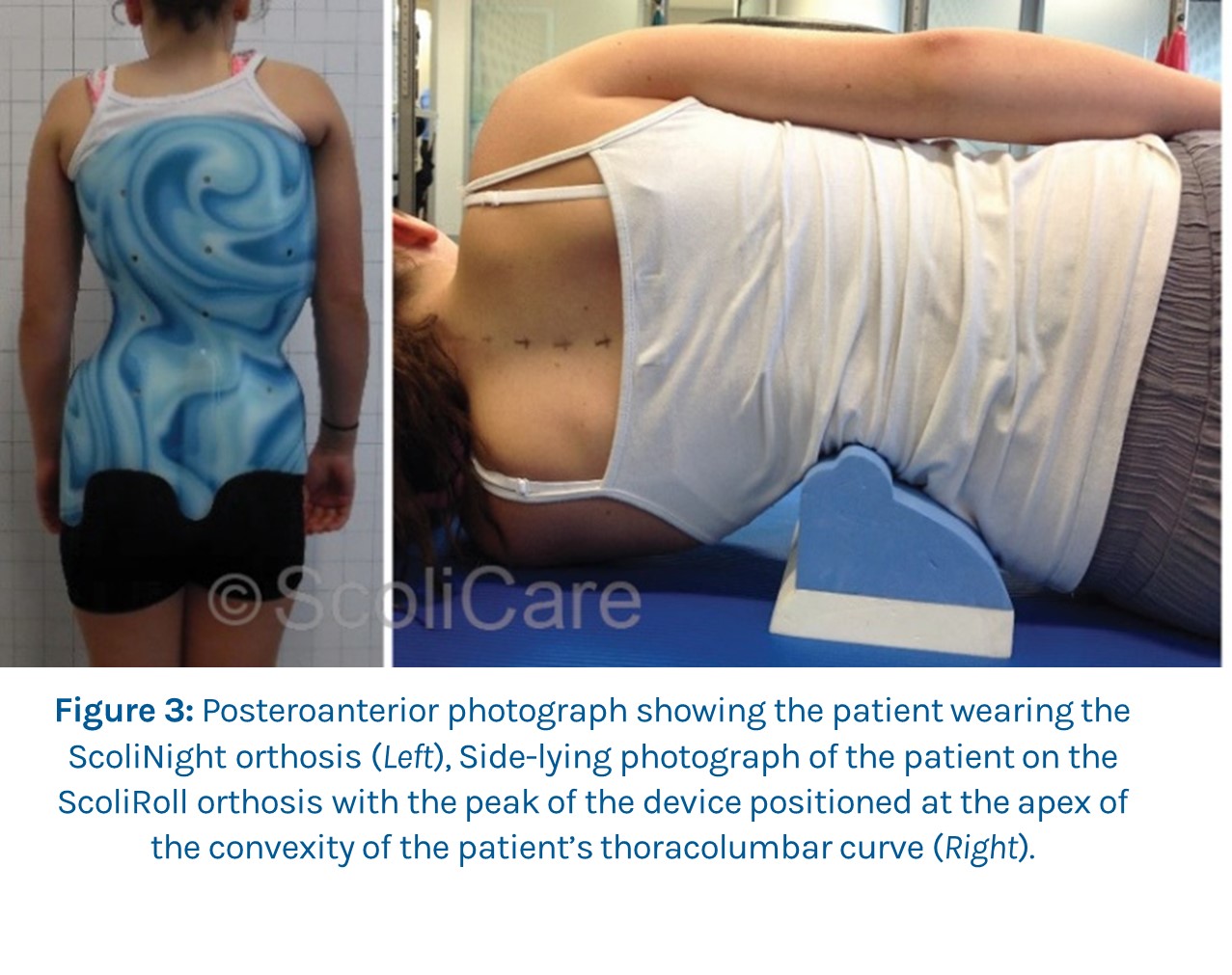 Case – 12 year old female adolescent patient – ScoliBrace