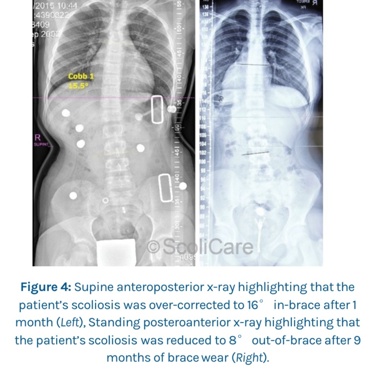 Case – 12 year old female adolescent patient – ScoliBrace