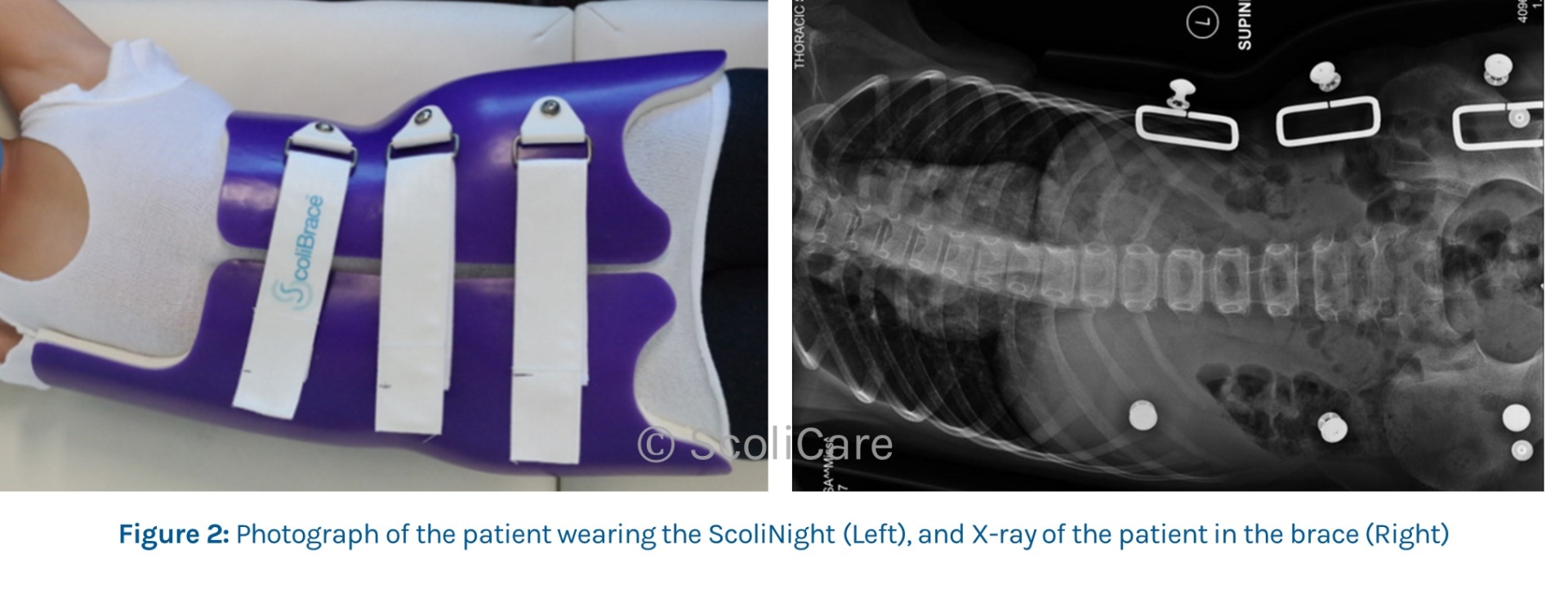 Case – 6 year old female juvenile patient – ScoliBrace
