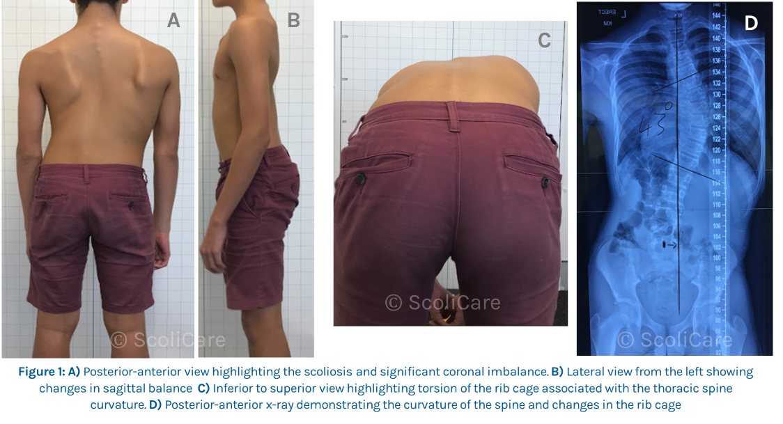 Case - 12 year old male adolescent patient – ScoliBrace