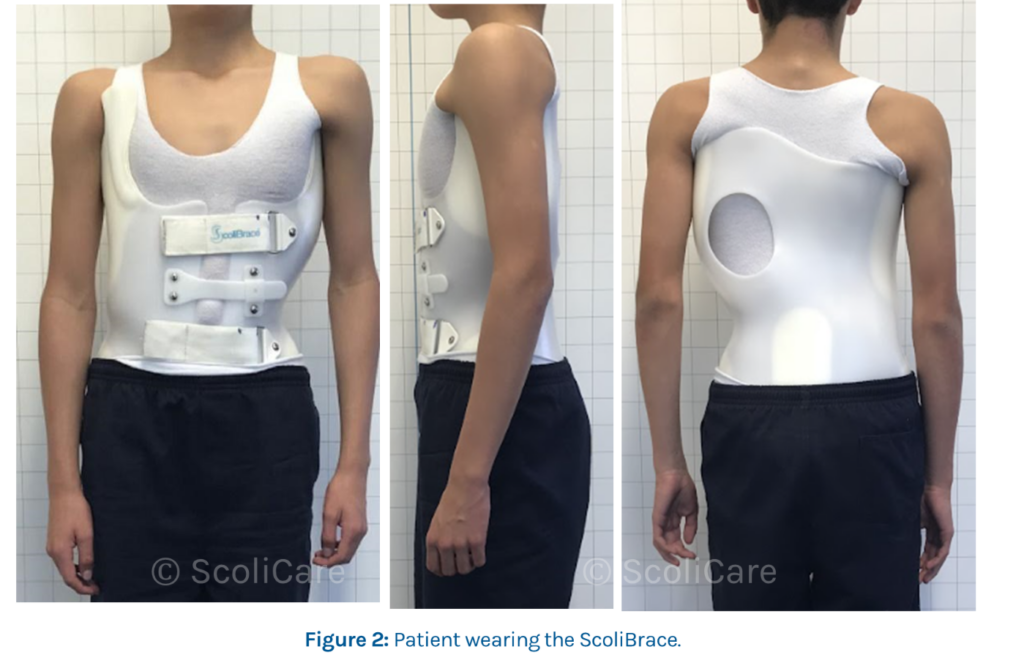 Case - 12 year old male adolescent patient – ScoliBrace
