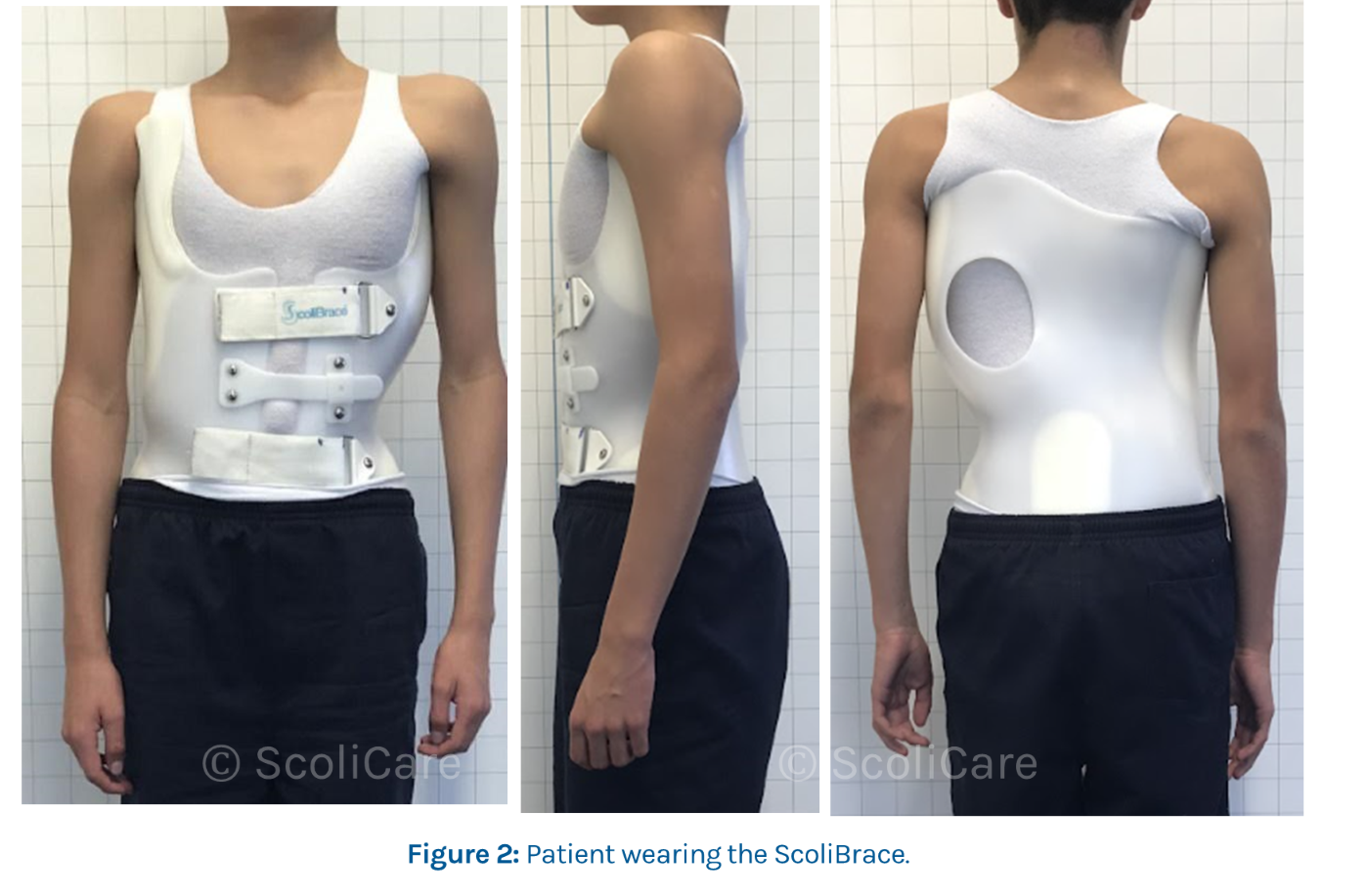 Case - 12 year old male adolescent patient – ScoliBrace