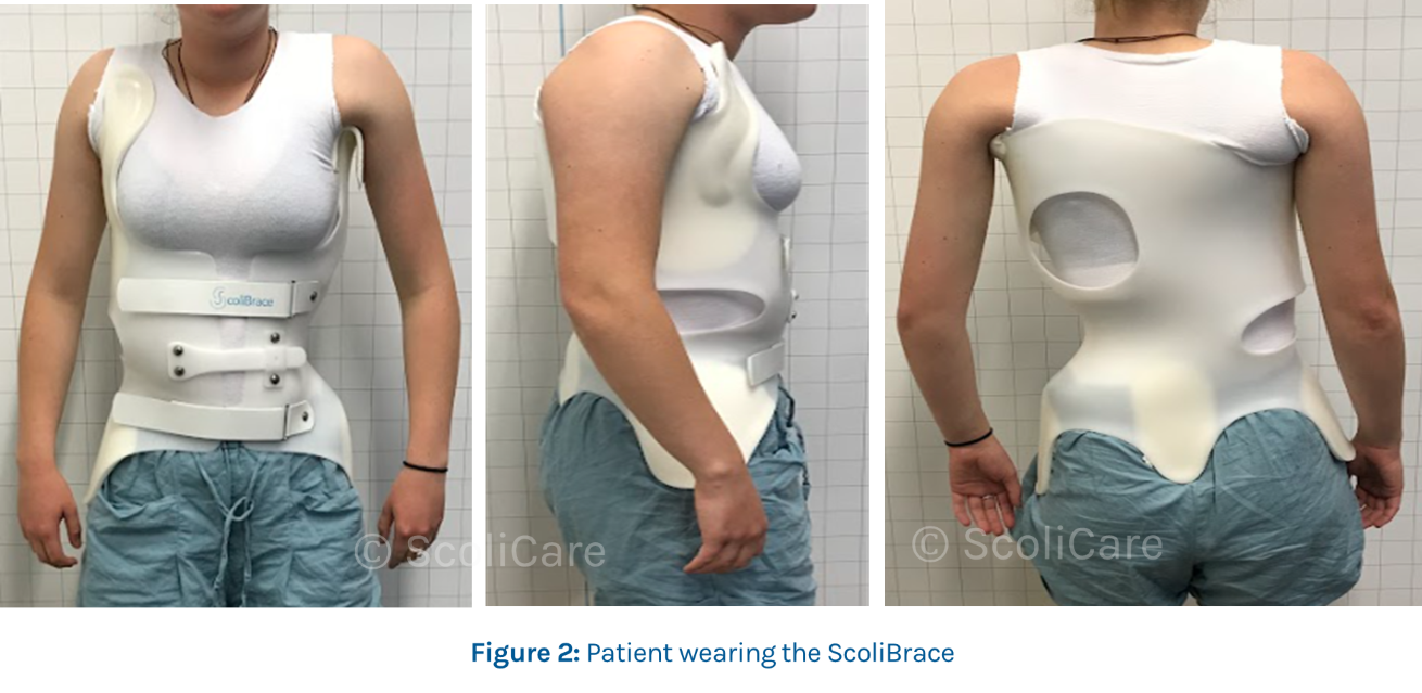 Case – 14 year old female adolescent patient – ScoliBrace