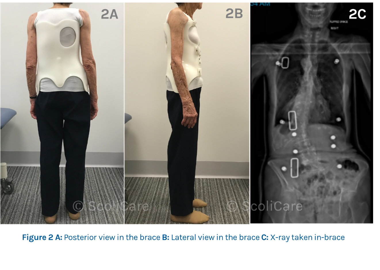 Case - 88 year old female patient – ScoliBrace