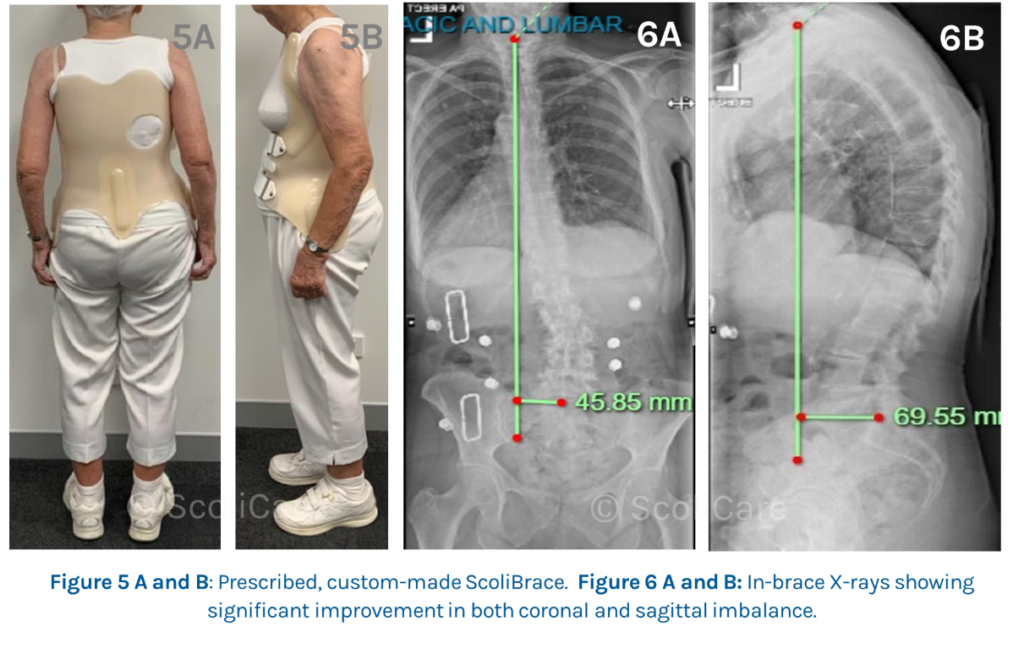 Case - 87 year old female patient – ScoliBrace